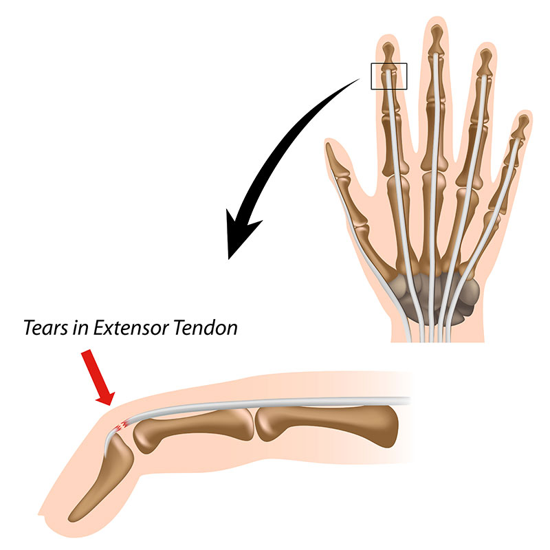 Mallet Finger - Brooklyn Premier Orthopedics